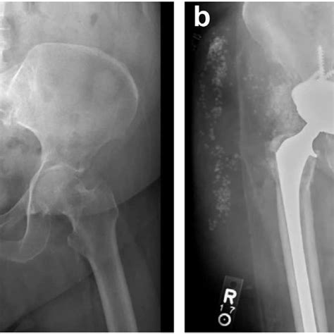 Case 3 A Preoperative Radiograph Of A Dislocated Constrained Liner