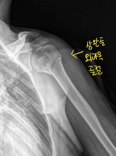 어깨골절 상완골 근위부골절 Proximal Humerus Fracture 금속판 Vs 금속정 수술방법 완벽정리 네이버 블로그