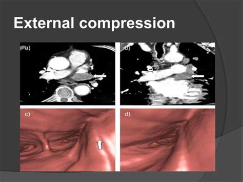 Ct Virtual Endoscopy 1 Pptx Digestive Disorders Diseases And