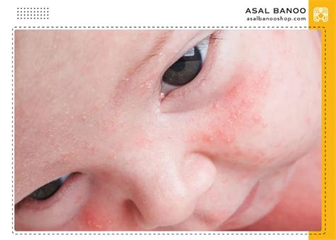 میلیا چیست؟ 7 روش درمان آن عسل بانو