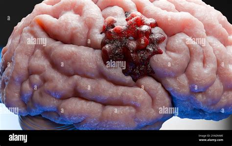 Human Brain Nervous System Anatomy Neural Cancer Sebaceous Bulb Brain Cancer Tumor Malignant