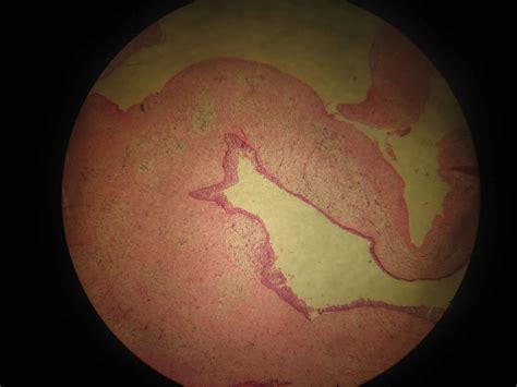 Dentistry And Medicine Lateral Periodontal Cyst And Sialodontogenic Cyst