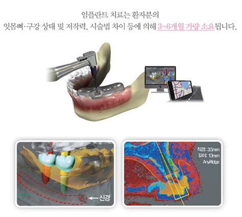 컴퓨터 분석 임플란트 메가탑치과