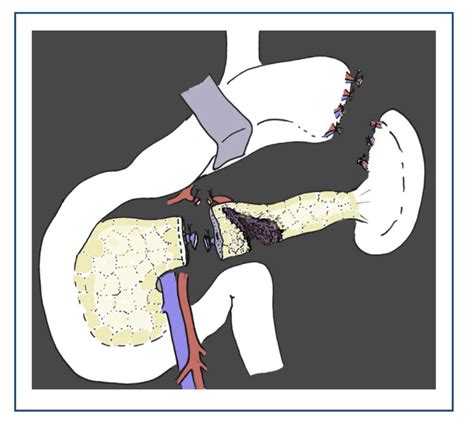 Cirbosque Some4surgery On Twitter Pancreatic Trauma Surgical Options Distal Pancreatectomy