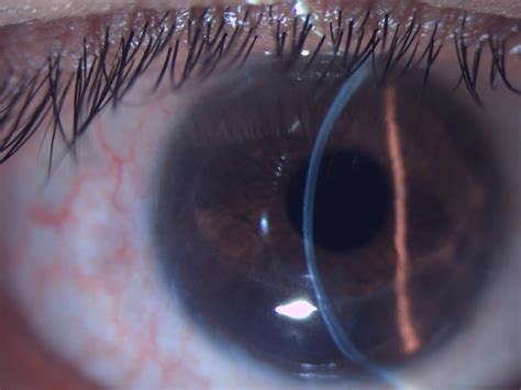 Pellucid Marginal Corneal Degeneration Md Searchlight