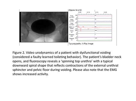 Urodynamic Differences Between Detrusor Underactivity And Dysfunctional