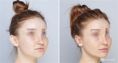 Korekcja Uszu Otoplastyka Chirurg Plastyczny Dr Maciej Kulicki