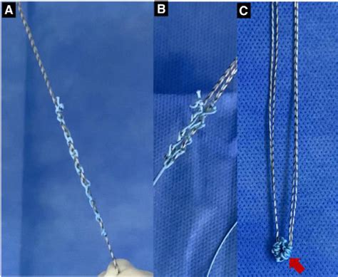 Pictures Demonstrating Anchor A Prepared Anchor B Anchor Looped