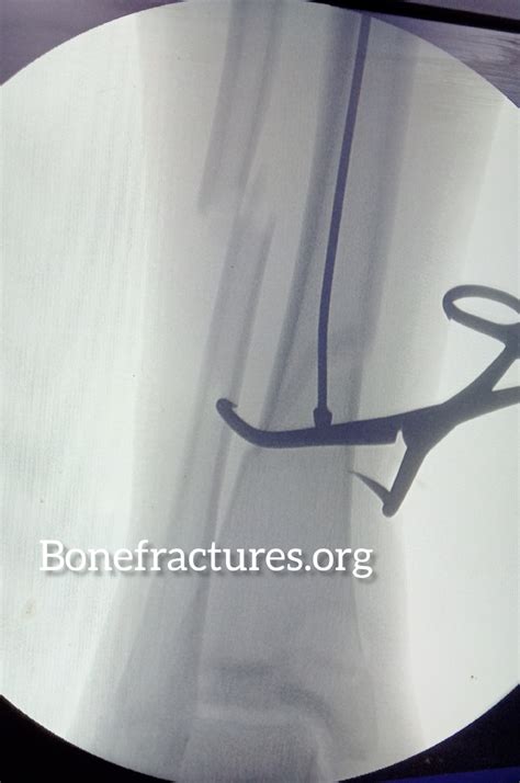 Reduction Of An Oblique Distal Tibial Fracture Using A Reduction Clamp And Fixation With An