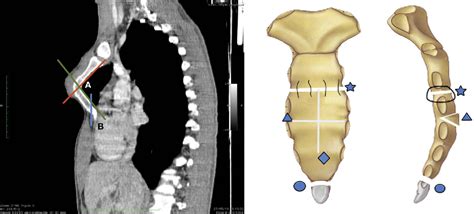 Figure 2 From Modified Ravitch Procedure For Left Poland Syndrome