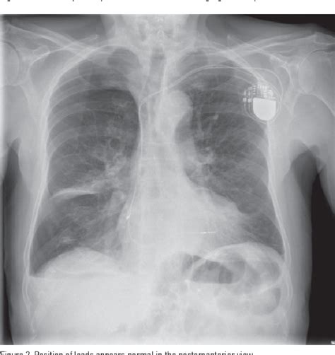 Figure 2 From Pneumothorax After Pacemaker Implantation Localized Contralaterally To The Side Of