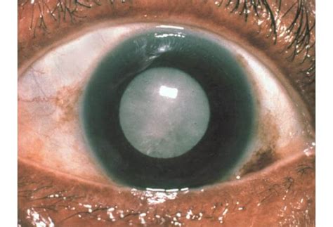 Mature Cataract Wills Eye Hospital