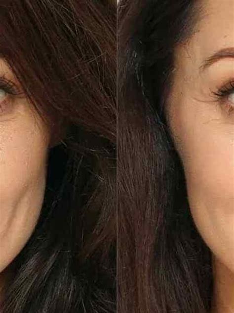 Calcium Hydroxyapatite The Future Of Collagen Stimulation Poliklinika Estetika Esencija Dr