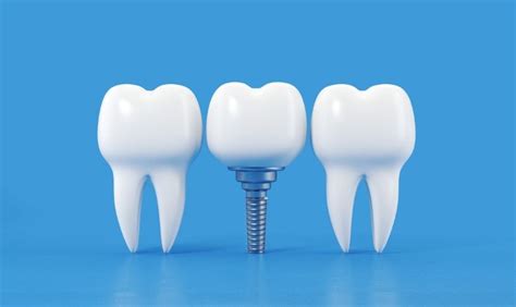 Can Dental Implants Get Cavities