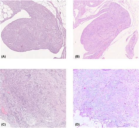 Histological Findings Of Regression A Complete Regression