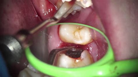 Gingiburs Gingivectomy Youtube