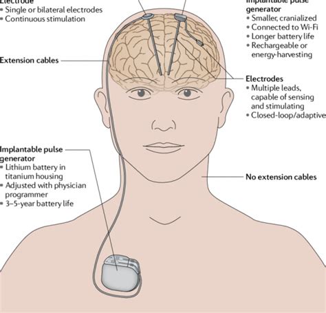 Understanding The Process Of Deep Brain Stimulation DBS Surgery Parkinsons Disease And