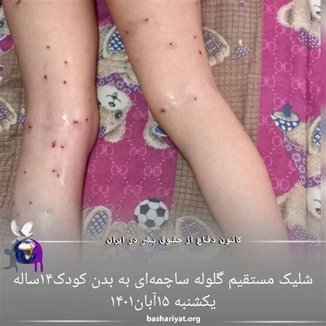 شلیک مستقیم گلوله ساچمه ایی به بدن کودک۱۴ساله سایت رسانه کانون دفاع