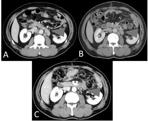 Figure 1 From Virchow Lymph Node Metastatic Recurrence Of Sigmoid Colon