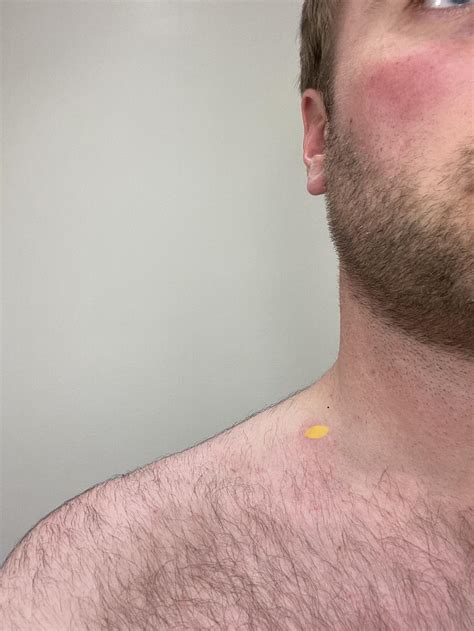 Swollen Supraclavicular Lymph Node R Askdoctorsmeeee