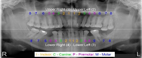 Figure 1 From Detection Of Proximal Caries At The Molar Teeth Using Edge Enhancement Algorithm