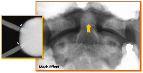 Mach Effect Radrounds Radiology Network