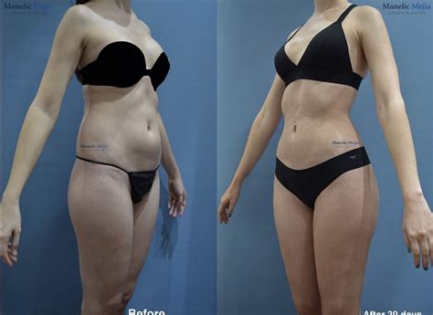 Lipo Vaser Dr Manelic Mejía