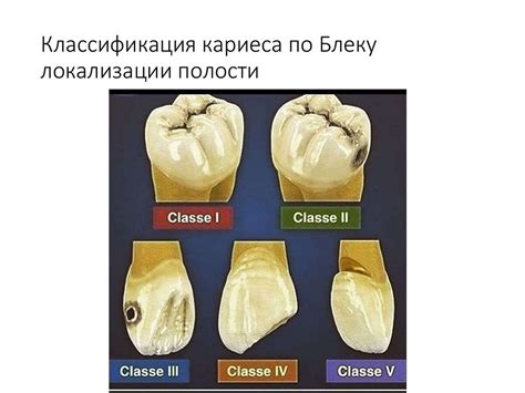 Понятие о кариесе классификация Патогенез развития кариозного