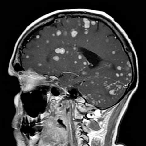 Vahid Shahmaei On Linkedin Mri Breast Metastasis Mrilogy Radiology Advanced Mri Radiologist