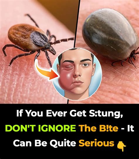 Kissing Bug Bites Silent Home Invaders Spreading Hidden Health Risks