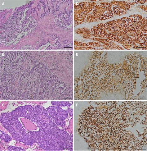 Clinicopathological Features And Prognostic Factors Associated With