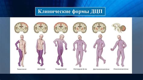 Детский церебральный паралич презентация онлайн
