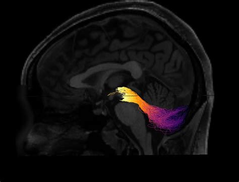 Putting Mrtrix Tractography Into PyAFQ Python Neurostars