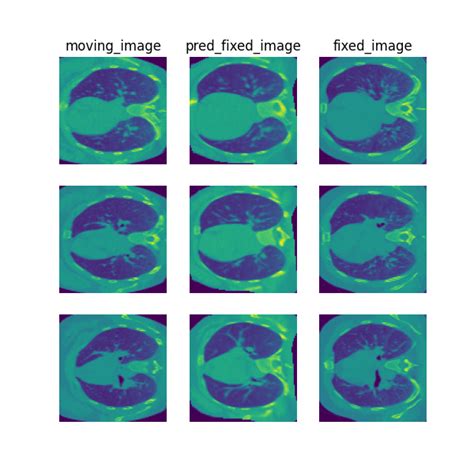 Unpaired Lung Ct Registration Deepreg Documentation