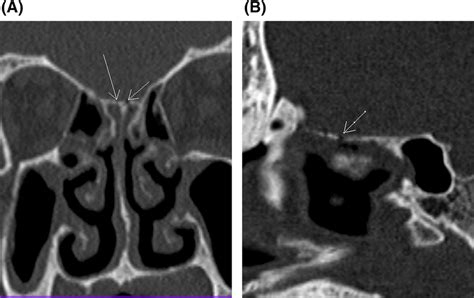 Ct Scan Of The Head With Bone Window A Linear Undisplaced Fracture