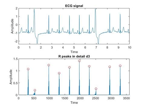 R Peaks Localization In An ECG Signal Of Human Suffering Of Arrhythmia Download Scientific