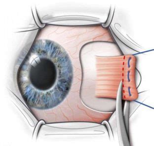 Traitement Chirurgical Du Strabisme Convergent Ophtalmologie
