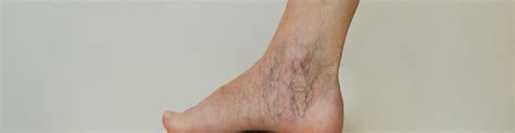 Varicose Vein Therapy Causes And Treatment For Your Veins