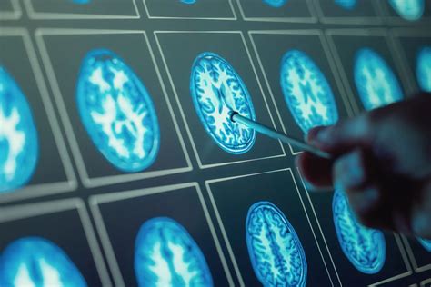 Guide To Non Hdl Cholesterol Levels Levels