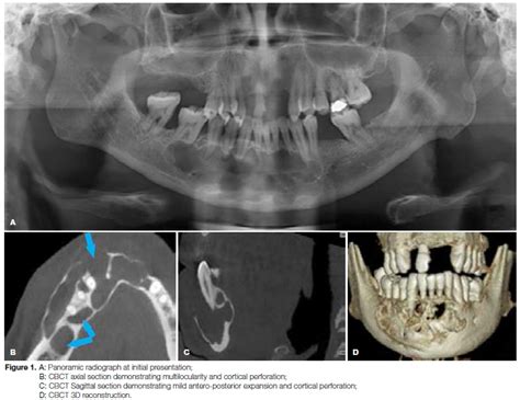 Glandular Odontogenic Cyst