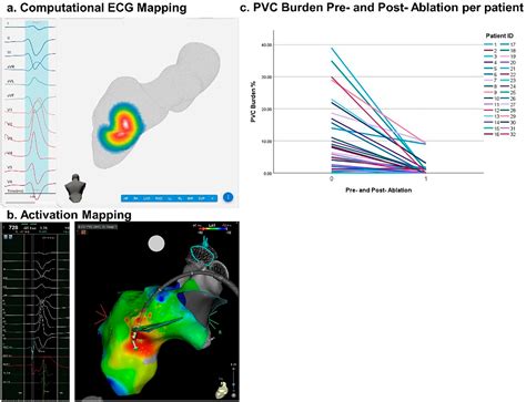 Po 06 117 Clinical Outcomes Of Prospective Computational 12 Lead Ecg