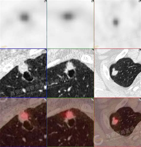 Pet Ct