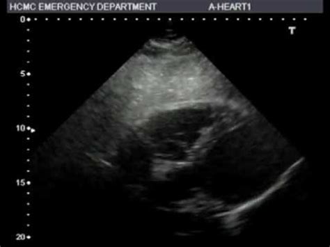 FAST Subxiphoid View YouTube