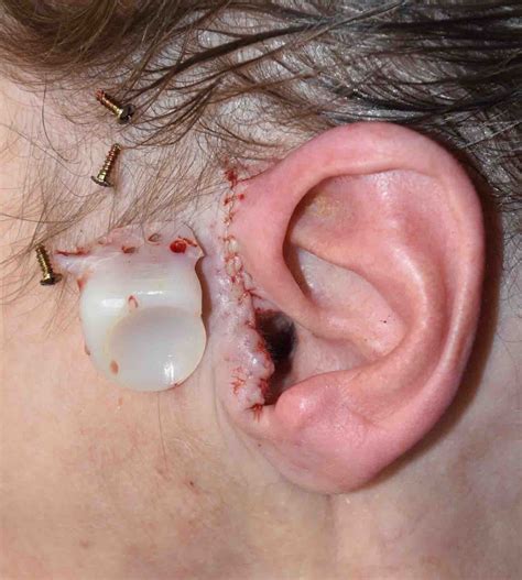 Or Snapshots Tmj Glenoid Fossa Implant Removal Explore Plastic Surgery