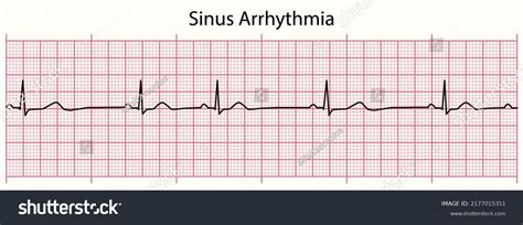 Sinus Arrhythmia