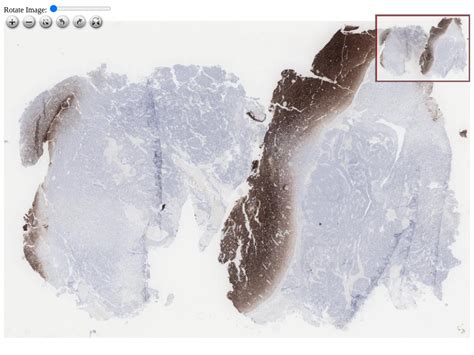 56 Glioma Histopathology Atlas