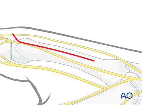 Radial Approach To The 2nd Metacarpal