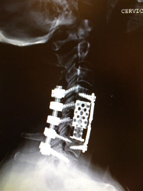 Use Of Titanium Expandable Vertebral Cages In Cervical Corpectomy