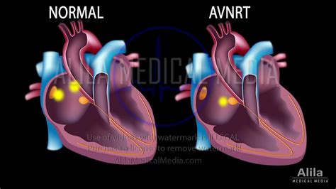 Av Nodal Reentrant Tachycardia