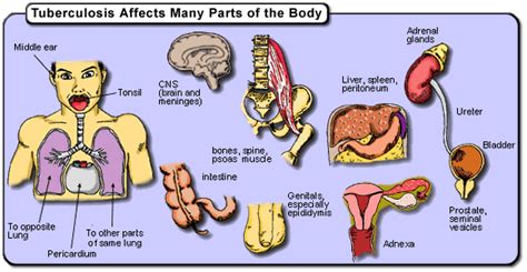 Diagnosis Of Extrapulmonary Tuberculosis Need Of The Hour Medchrome
